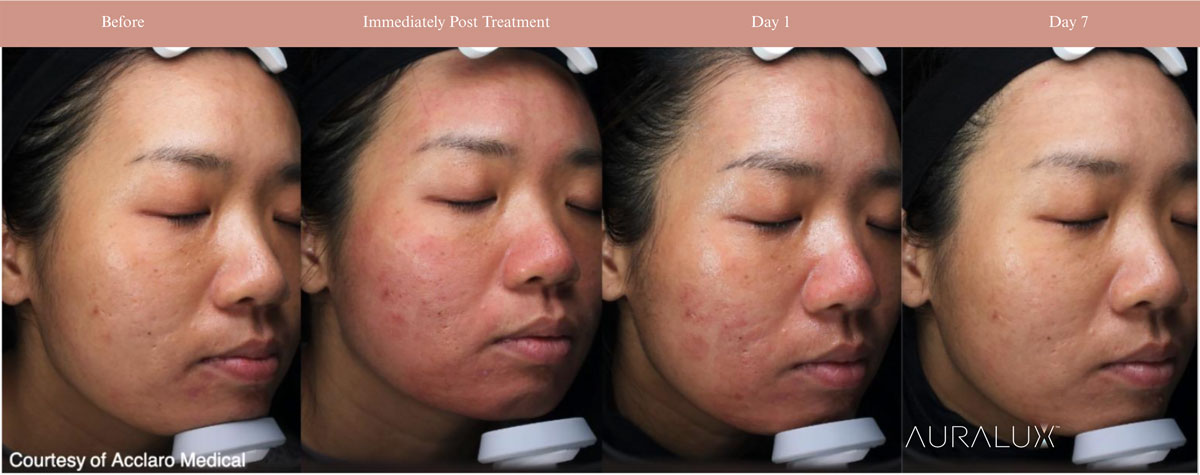 AuraLux Peoria | Laser Skin Rejuvenation Peoria